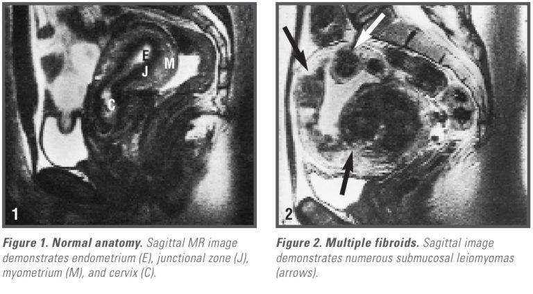 Uterine Fibroids: Evaluating Leiomyomas with MRI, CT and Ultrasound